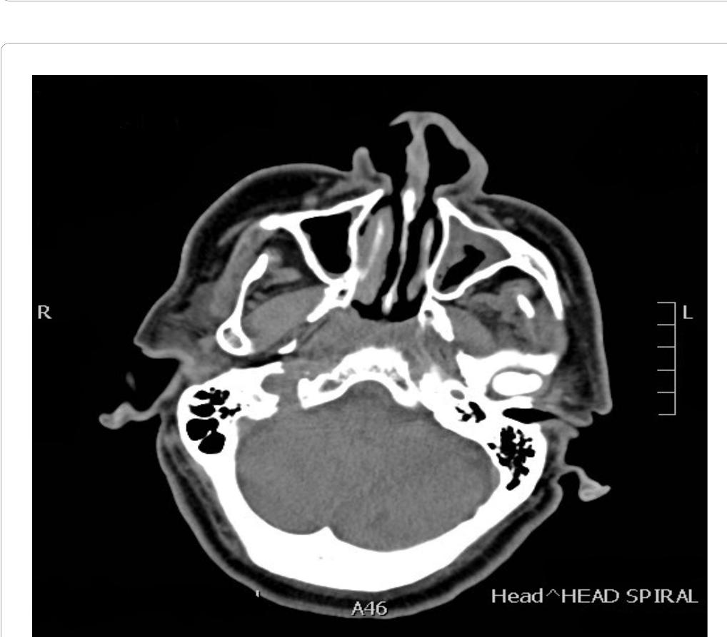 Sinus ct: soft tissue densities around maxillary and ethmoid