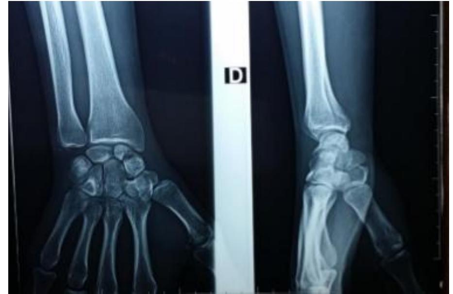 -2: standard radiograph of the right wrist: face and profile