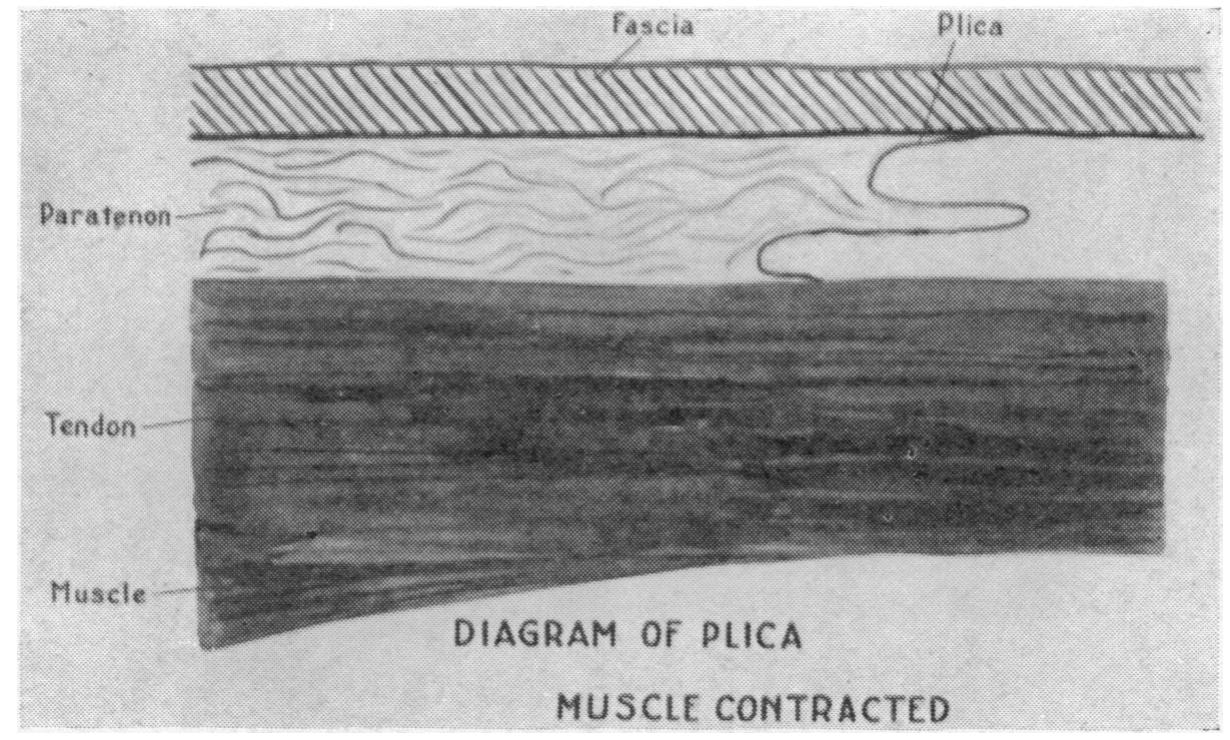 Diagram of the plica falciformis at the proximal pole of the