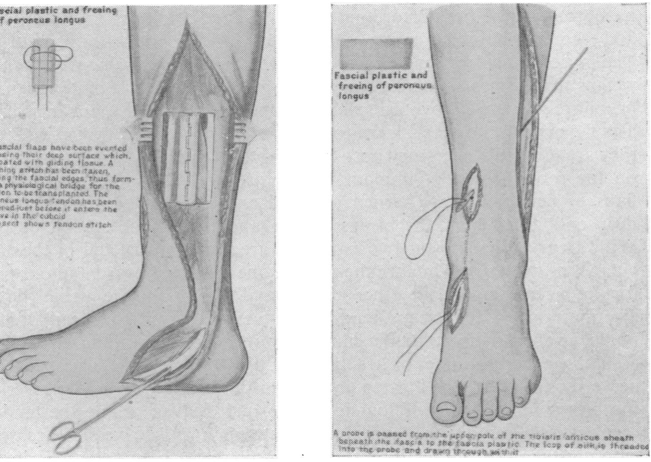 Figure 11 - The evolution of modern tendon surgery