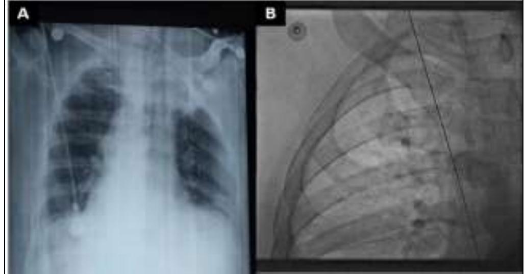 -1: central venous catheter (cvp) guidewire location on