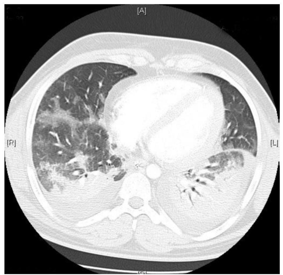 Ct thorax of acute respiratory distress syndrome with