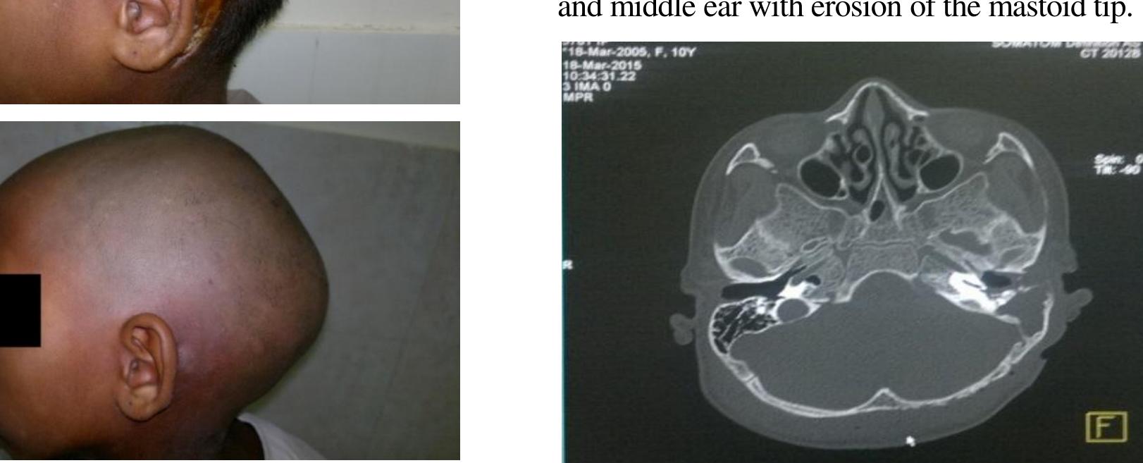 Figure 2 - Citelli’s Abscess Following Otitis Media: A Case