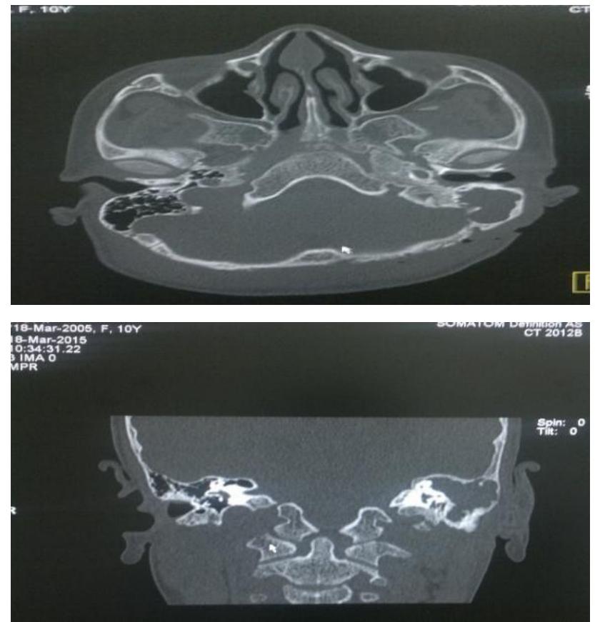 Figure 5 - Citelli’s Abscess Following Otitis Media: A Case