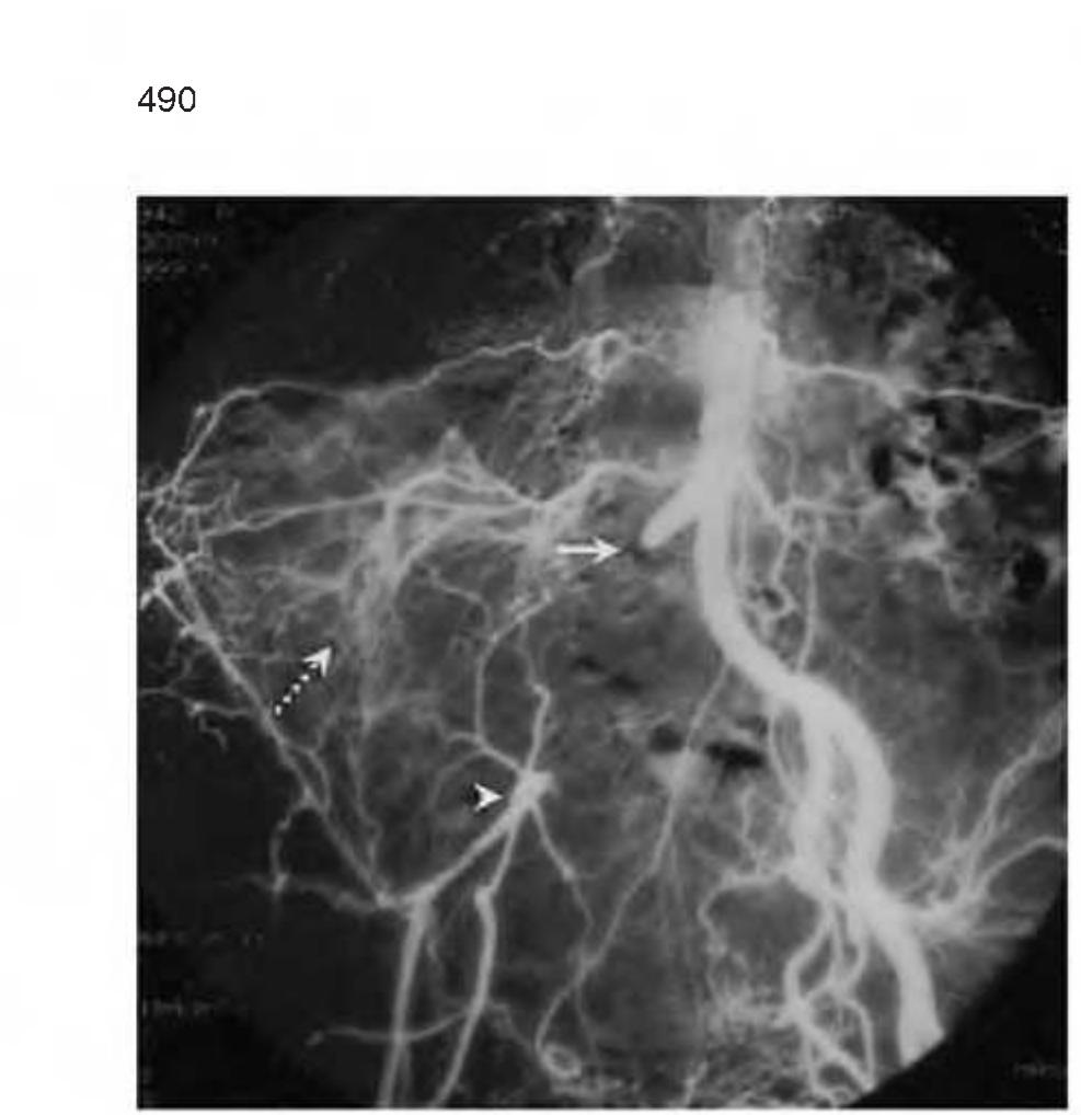 Arteriography: right iliac artery occlusion (arrow) with