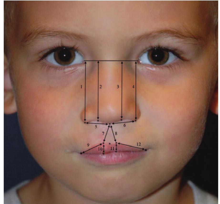 Postoperative frontal view measurements. 7, cleft alar base