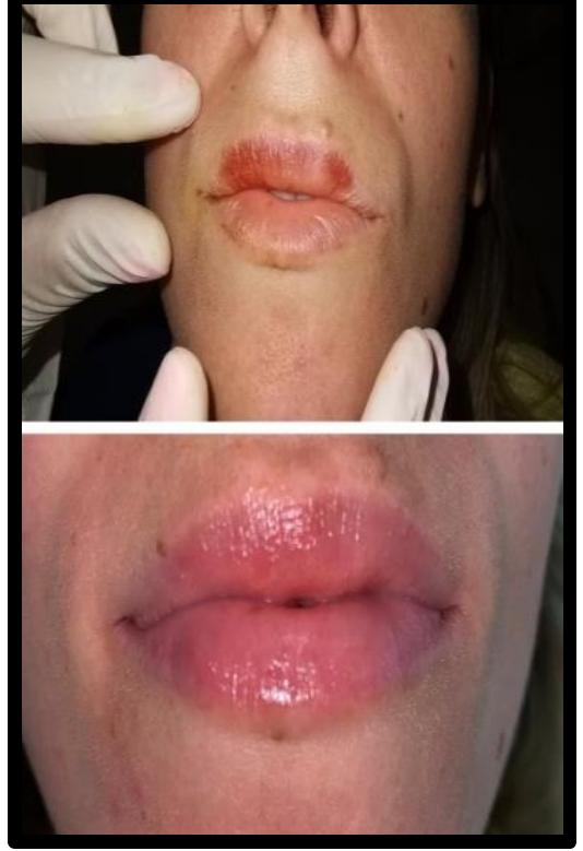 Erythematous lesions on upper lip.