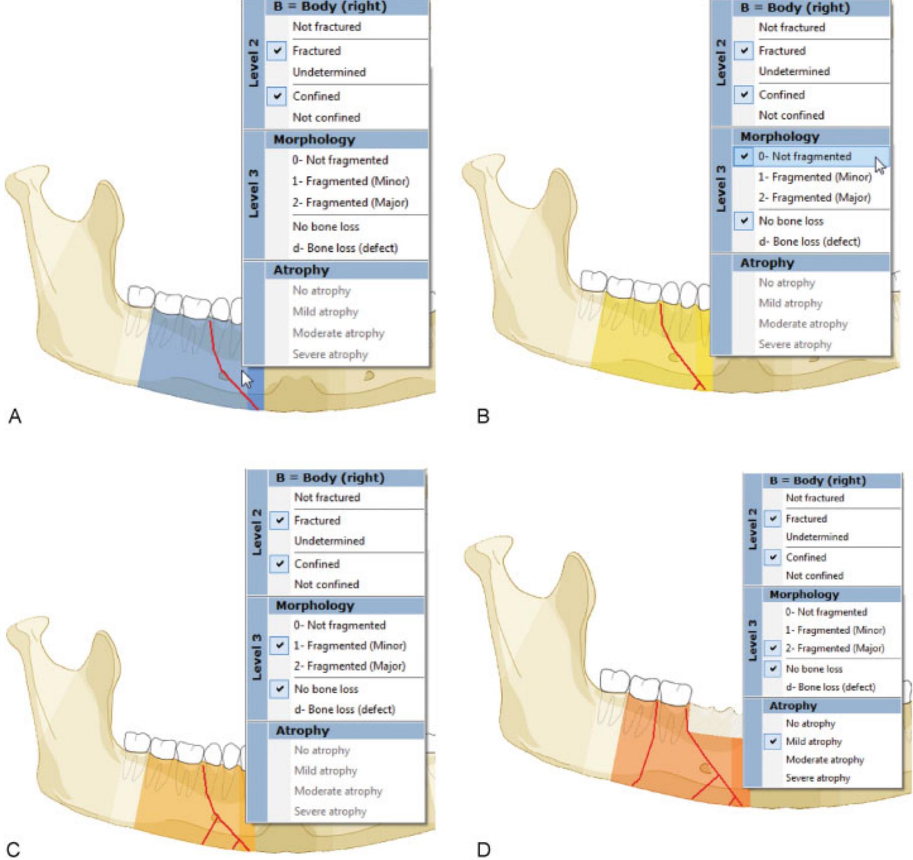 Classification by fracture drawing or mouse click. (a) a
