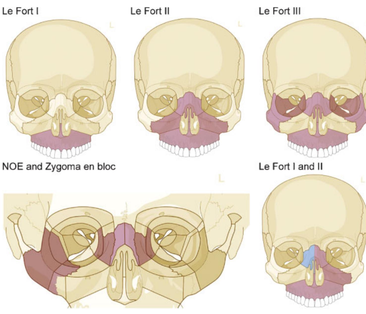 Common midface fracture patterns available for