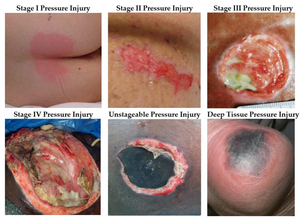 Stages of pressure injuries (adapted from [1]). pressure