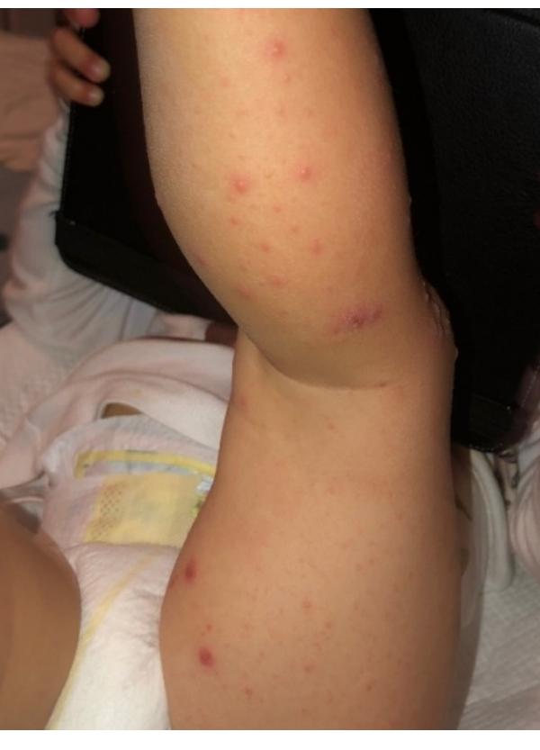 Extensor surface of knee of 2-year-old male showing vesicles