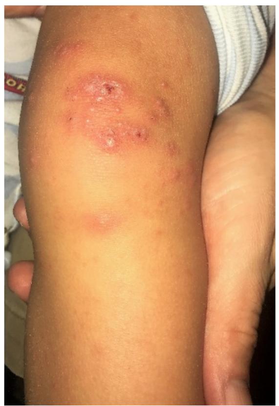 Multiple papulovesicular eruptions and evolving blisters on