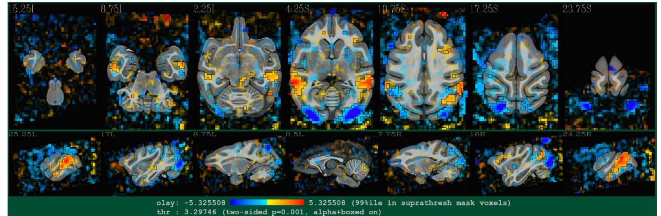 Example of a task-based fmri contrast map automatically