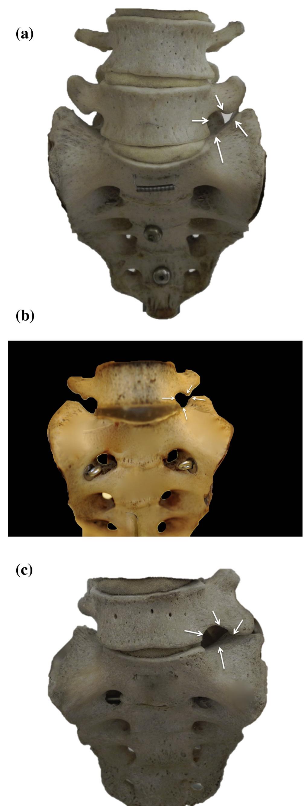 (a-c) three examples of type iii bony morphology with a