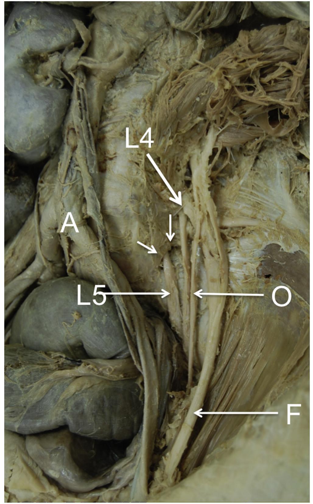 Dissection of the left-sided posterior abdominal wall. the