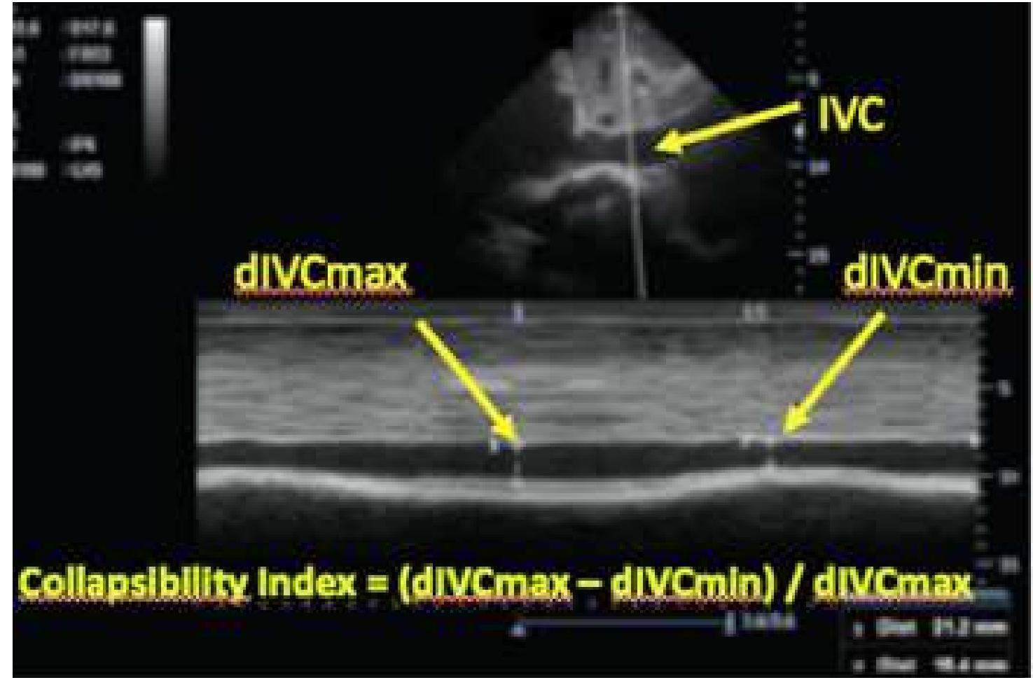 Ultrasound measurements of inferior vena cava (ivc) and