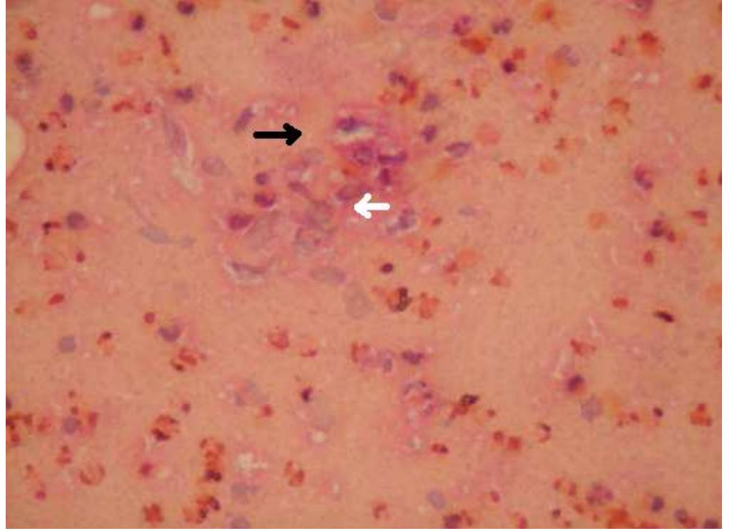 Fine needle aspiration biopsy from the gluteal region