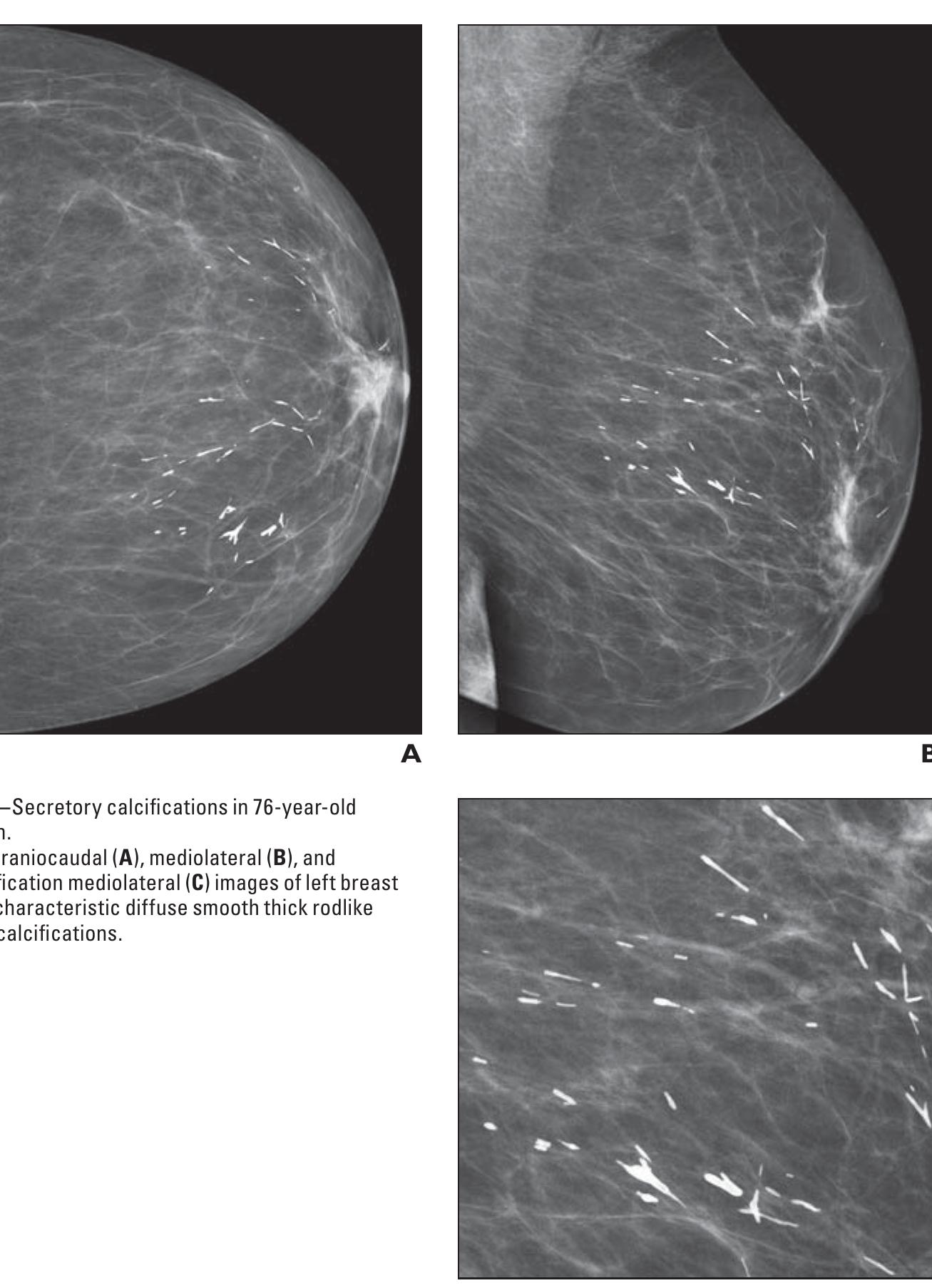 Bris within dilated ducts produces smooth thick rod-shaped