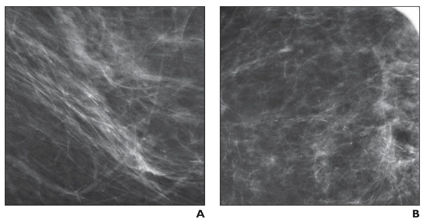 —ductal carcinoma in situ with invasive ductal carcinoma in