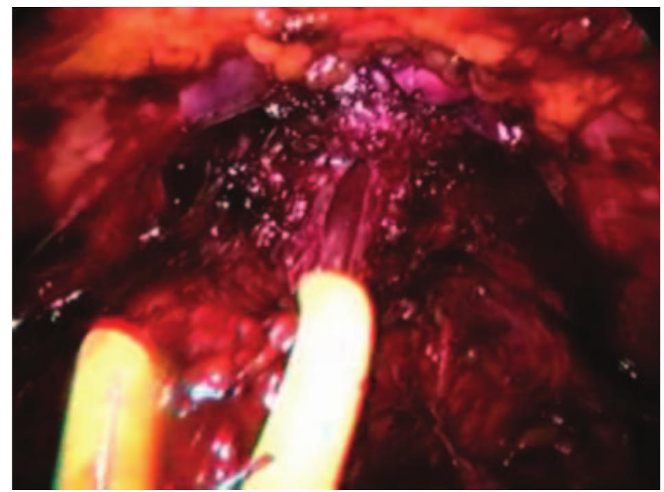 Apical dissection section of urethra. the anterior aspect of