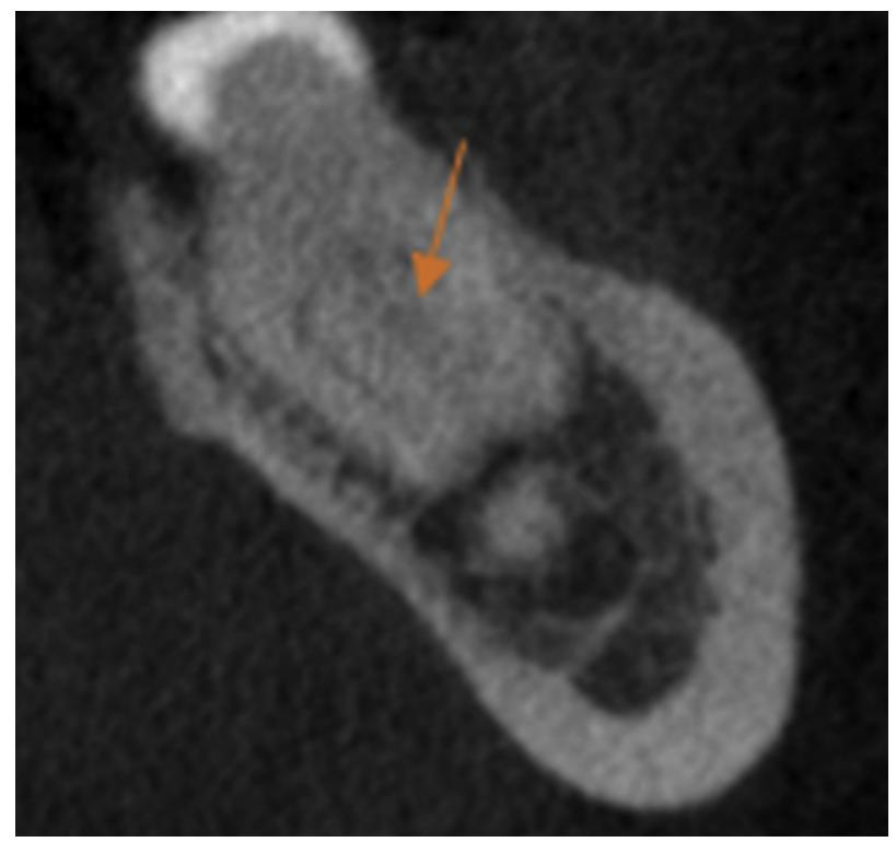 A coronal cbct image showing the middle mesial canal of