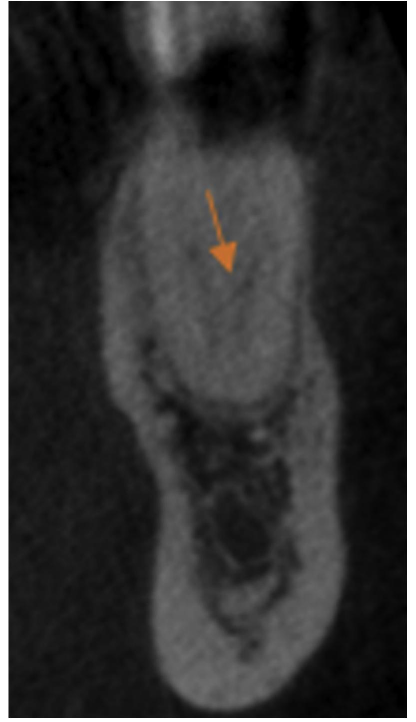 A coronal cbct image showing the isthmus of tooth #19. the
