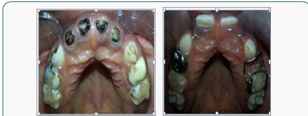 Intraoral a. pre-op photograph of lower occlusal view