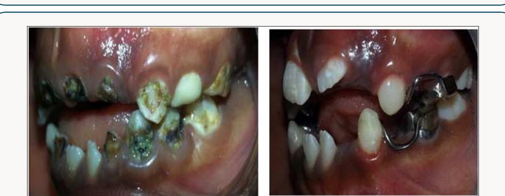 Intraoral a. pre-op photograph lateral view is showing