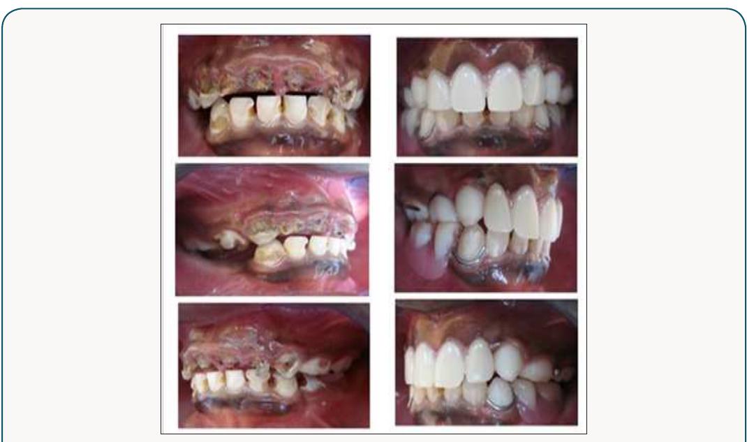 A. frontal views of photographs showing severe with root