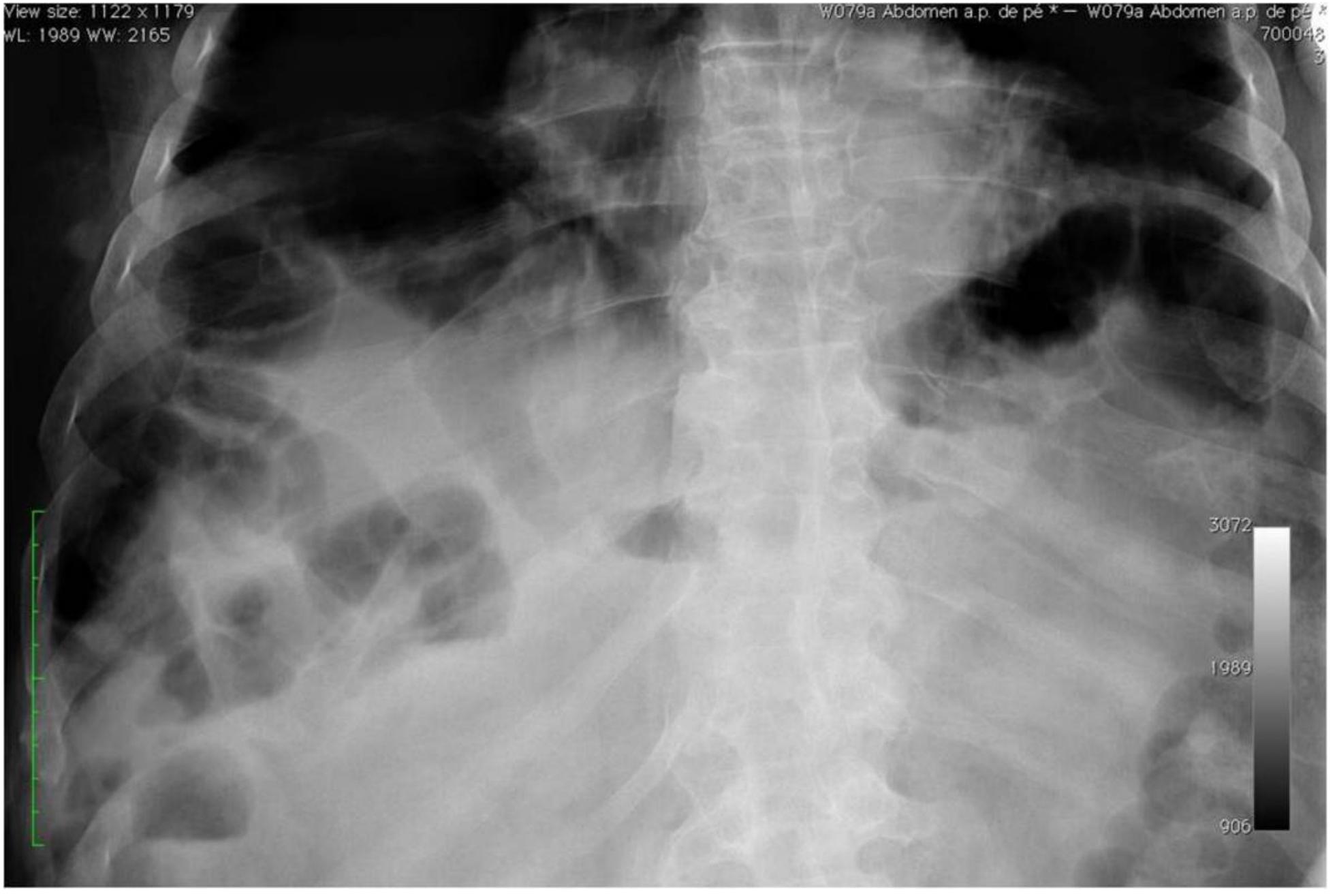 Chilaiditi sign - abdominal radiograph: visualization of a