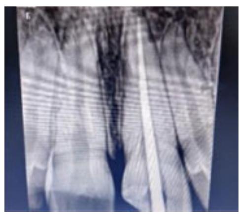 Master cone radiograph. figure 3: working length radiograph.