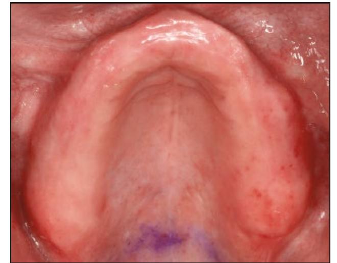 Occlusal view of the maxilla. fig 4 finger retraction of