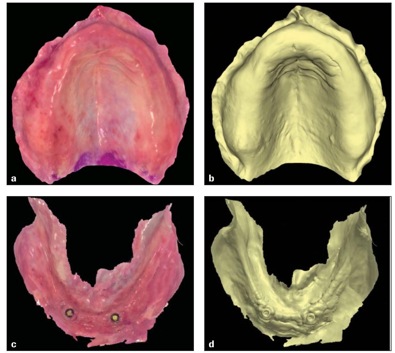 (a) intraoral scan of maxillary arch in color. (b) maxillary