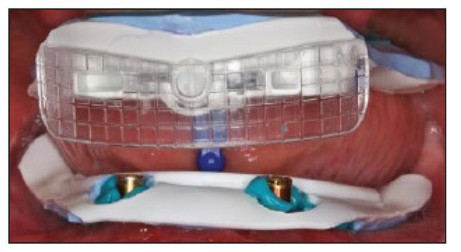 Intraoral scan of gothic arch-tracing device. fig 7 gothic