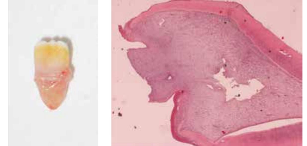 Natal tooth after extraction. fig. 2 optical microscopic