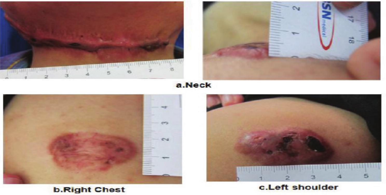 Keloid lesions on the fourth intralesional injection. a) 13
