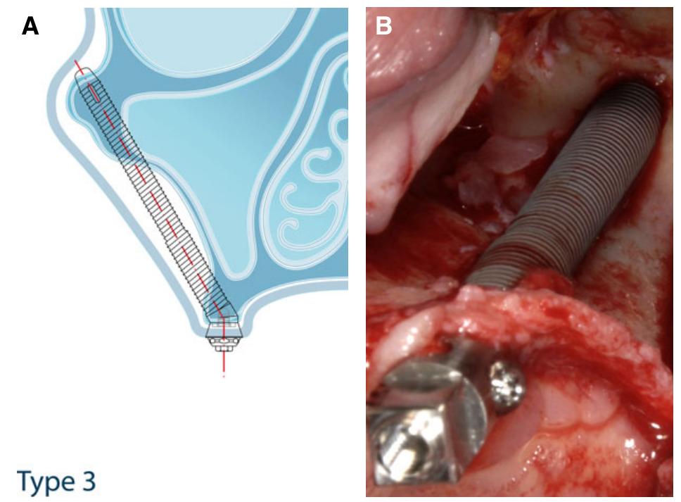 Schematic (a) and clinical (b) examples of a zygo- matic