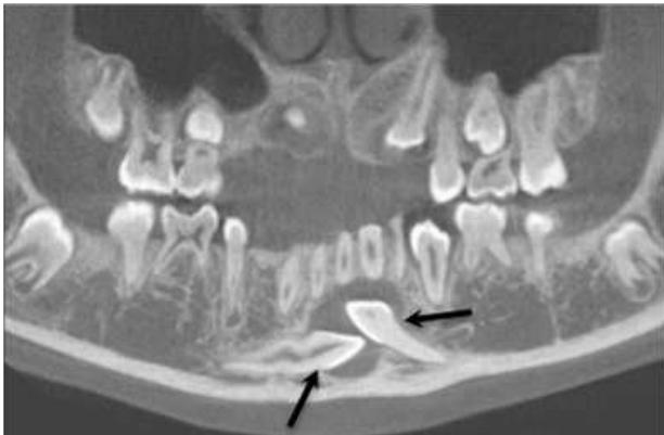 Sagittal cbct image shows erosion and expansion of the