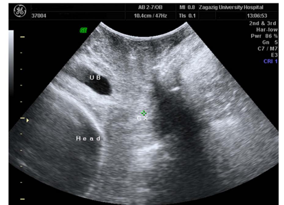Normal anatomy by transperineal approach, the cervix is