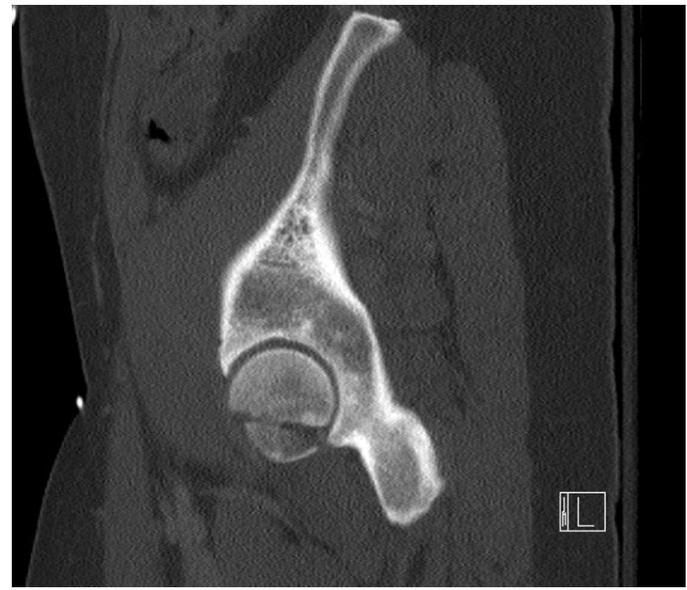 Sagittal ct scan slice of femoral head fracture fragment.