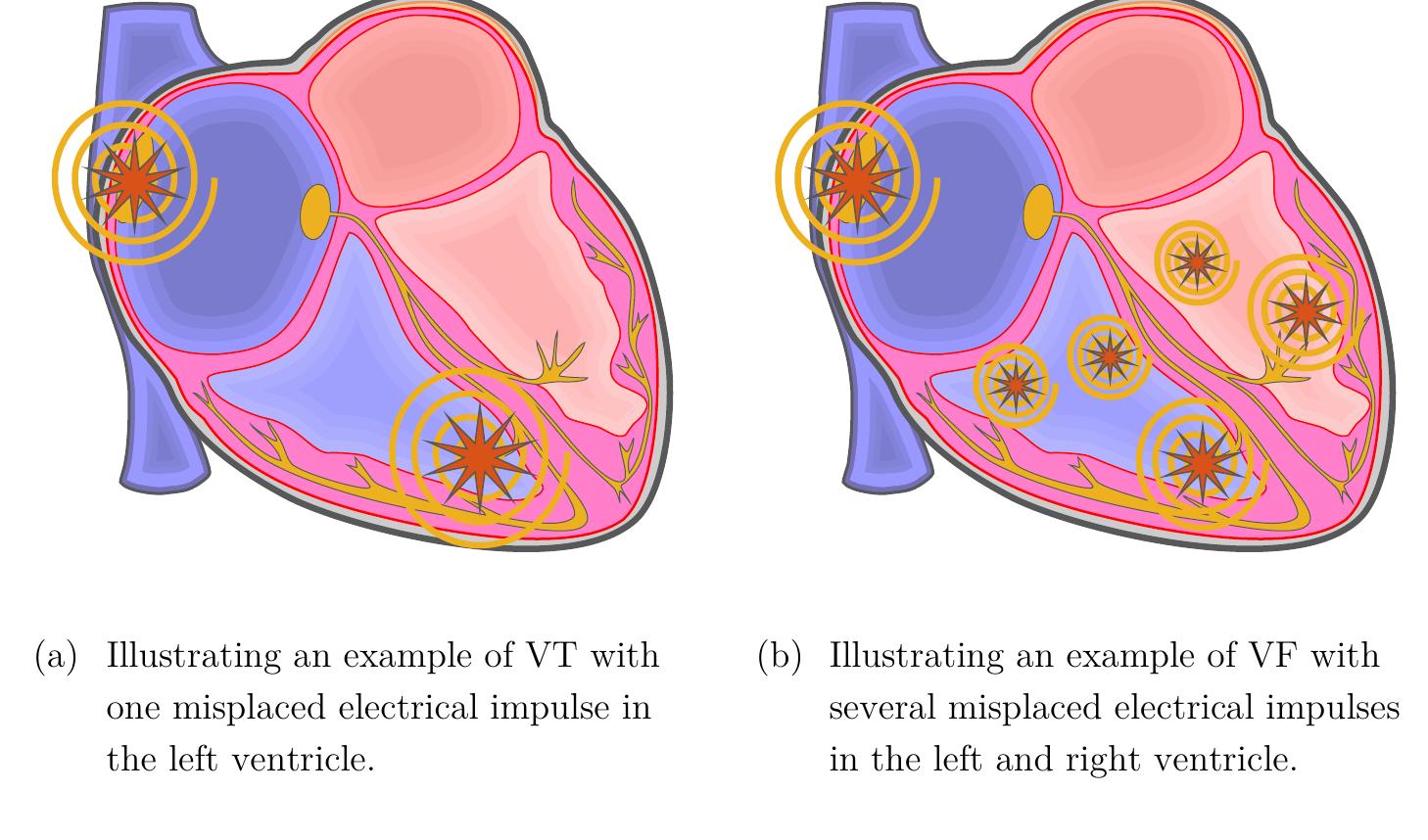 5. examples of ventricular arrhythmias showing misplaced