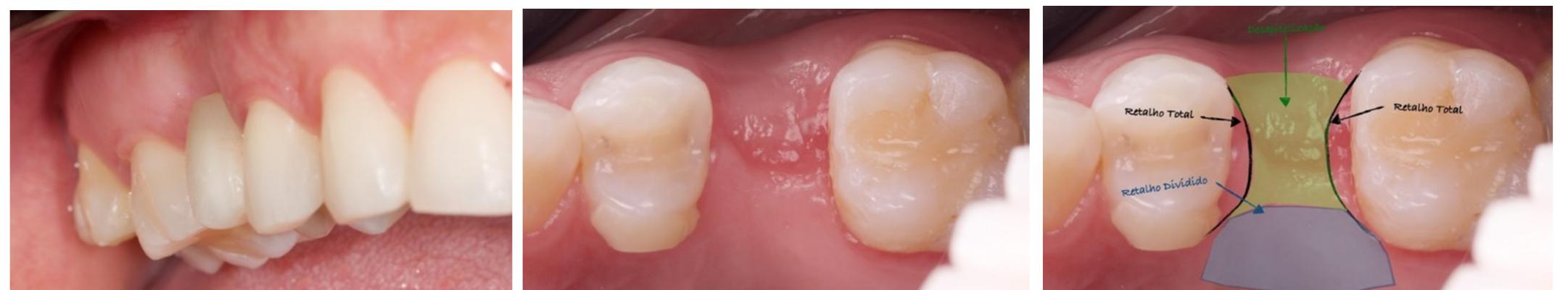 - surgical incision planning. figure 1 - region of tooth 14,