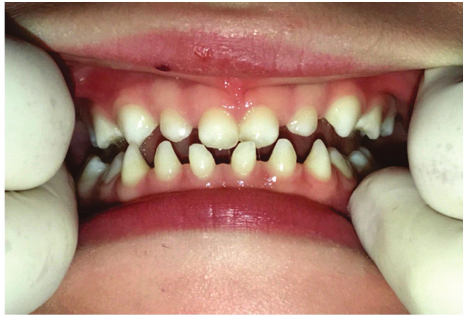 Ds patient, 3 years old male, with lower incisor