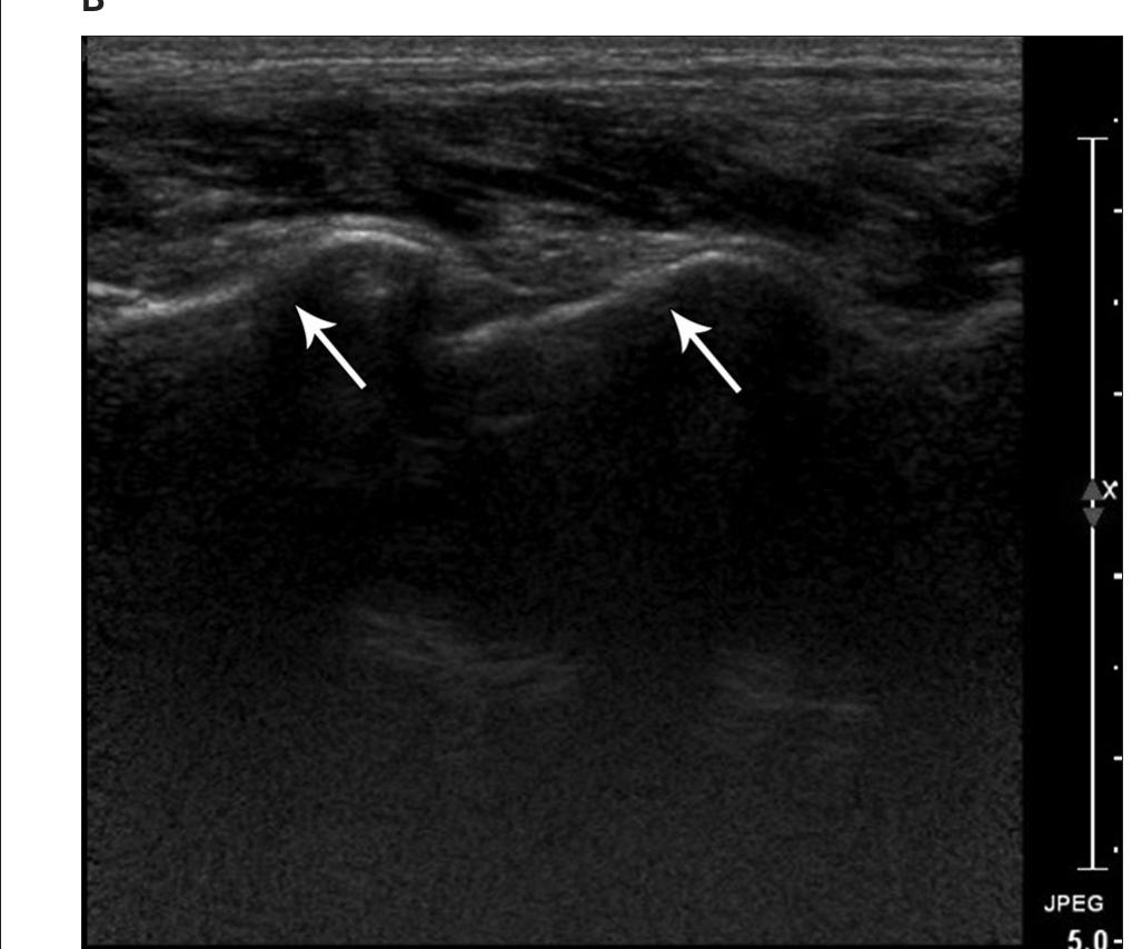 Longitudinal sagittal and parasagittal spinal sonograms from