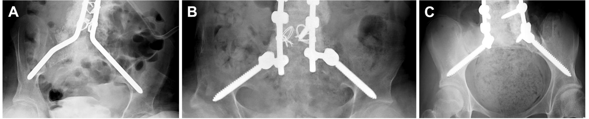 Anteroposterior pelvis radiographs show three types of